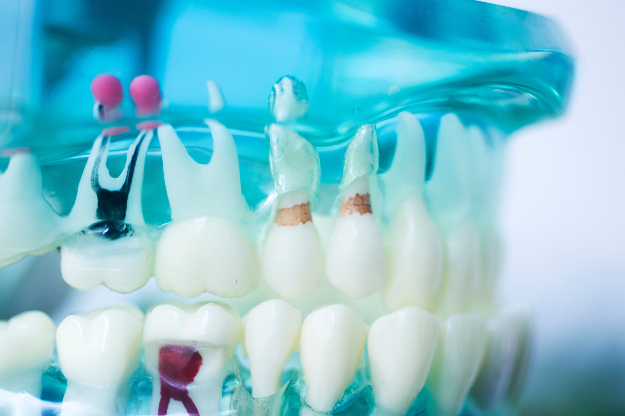 How Root Canals Prevent Tooth Loss | Brighton, MA